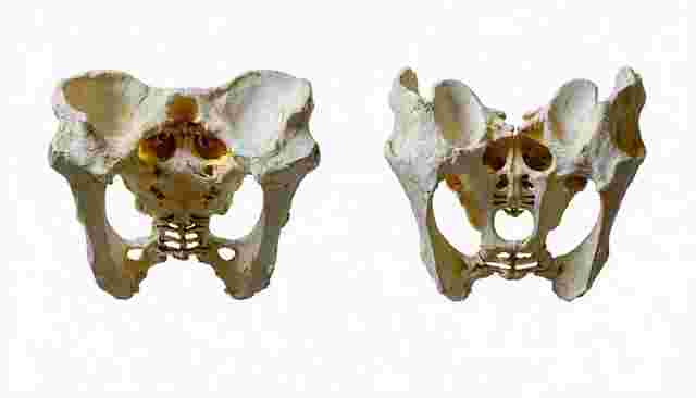 Comparison of True and False Pelvis & Sexual Dimorphism